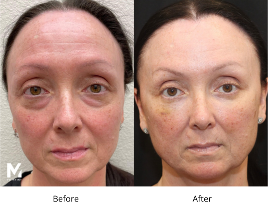 Microfat/Nanofat Skin Enhancement Las Vegas | Dr. Myint