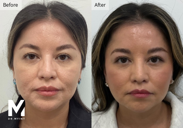 Facial Fat Transfer Las Vegas with Microfat | Dr. Myint